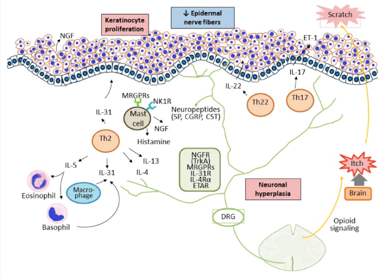 Pathophysiology – Prurigo Nodularis